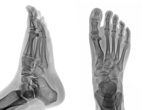 X Ray Of Foot Foot Radiograph (an Approach) | Radiology Reference